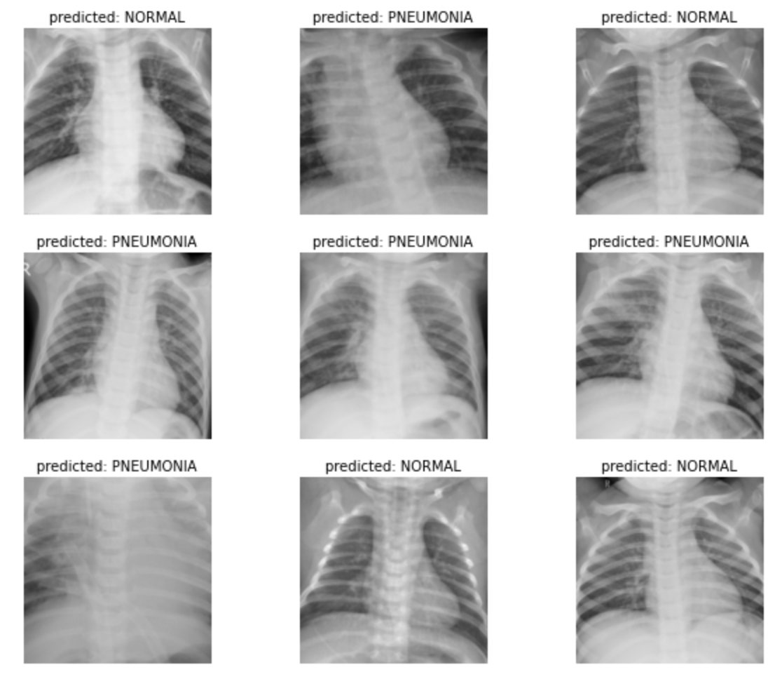 Using Deep Learning to detect Pneumonia in X-ray images | onpointai